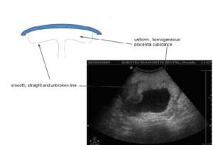 Ultrasound Teaching Module on Placental Grading