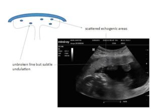 Ultrasound Teaching Module on Placental Grading