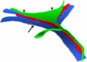 Triangular Cord Sign Of Biliary Atresia